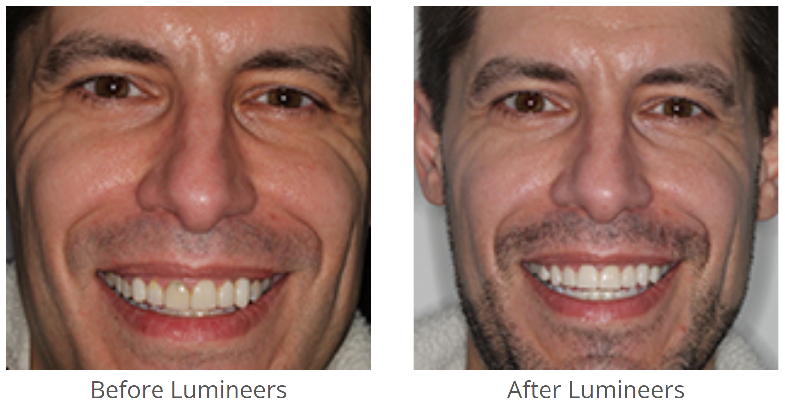 Lumineers Before and Afters from Real Patients - Hinsdale Dentistry